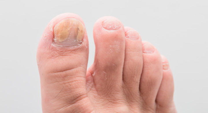 Patologías comunes - Podología, Fisioterapia y Biomecánica en Madrid ...